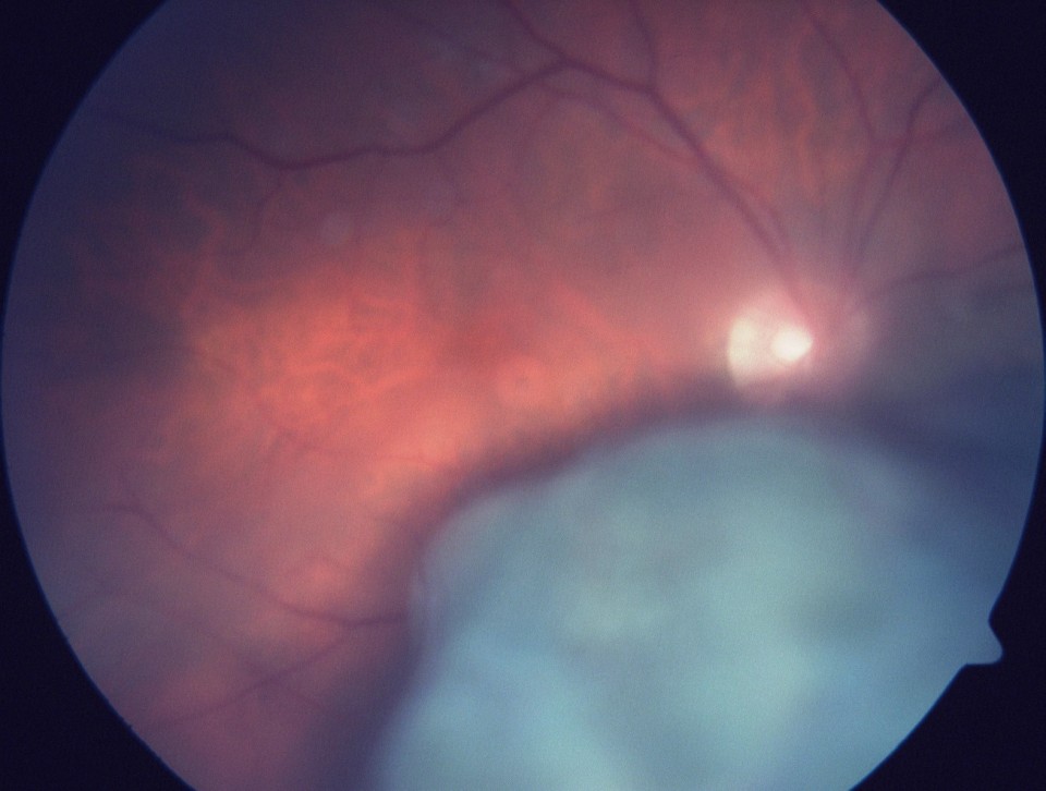 Intraocular Melanoma: Symptoms, Diagnosis and Treatment