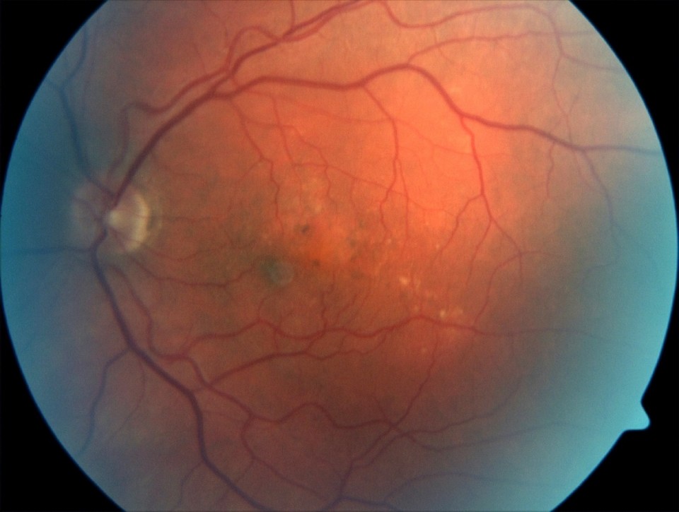 Retinal Vascular Diseases: Symptoms, Prevention & Treatment